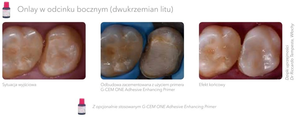 G-CEM ONE Twin Refill 2x4,6g - Producent: GC - Cena: 520,00 zł - - Id ...